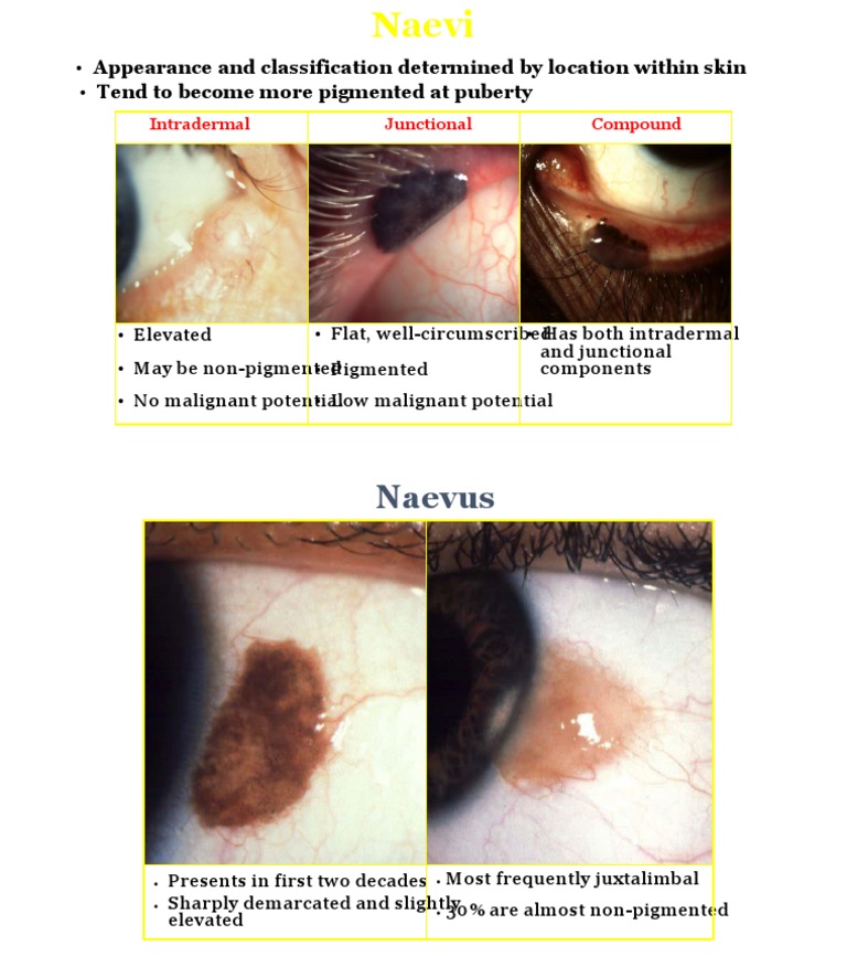 Types and classification of skin moles (naevi | PDF