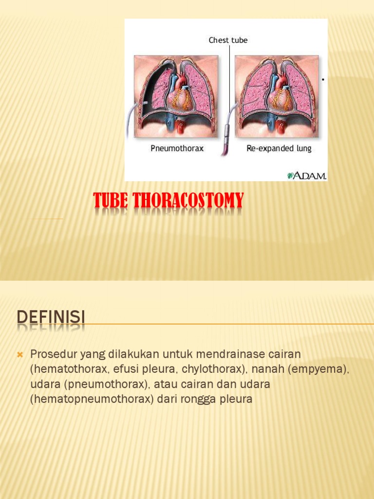 Tube Thoracostomy | PDF