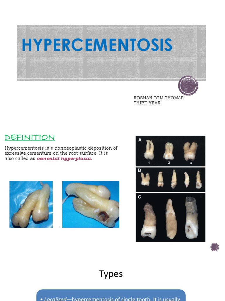 Hypercementosis: Roshan Tom Thomas Third Year | PDF | Dental Anatomy ...