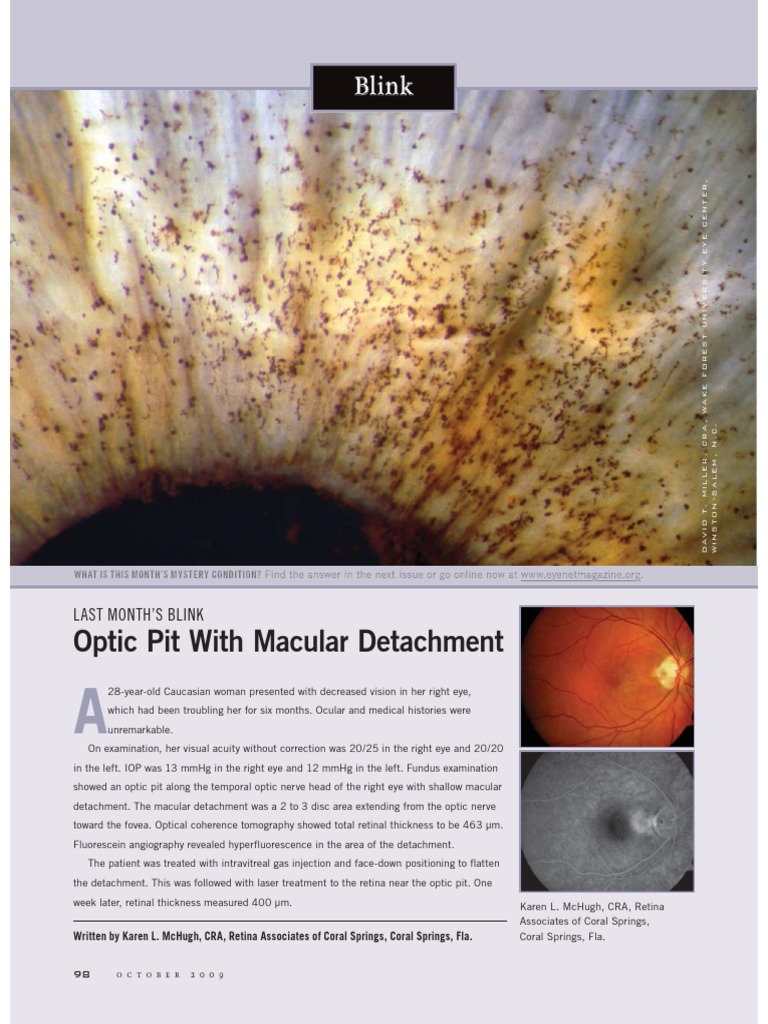 Optic Disc Pit | PDF | Science & Mathematics