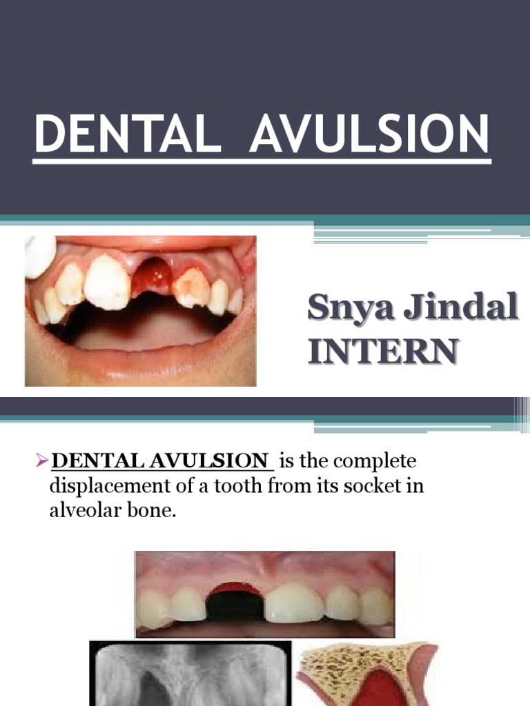 Dental Avulsion: Snya Jindal Intern | PDF | Mouth | Dentistry