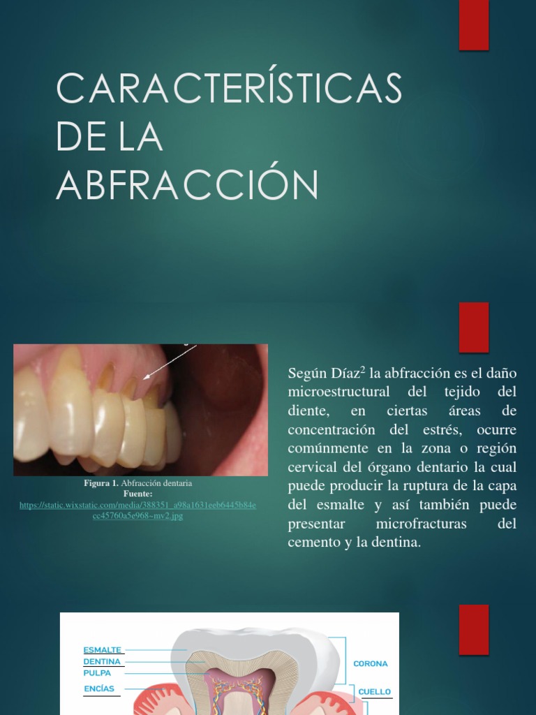 Características de La Abfracción | PDF | Esmalte de dientes | Diente