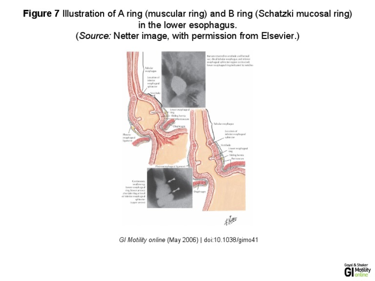 Esophageal A and B Rings Diagram | PDF