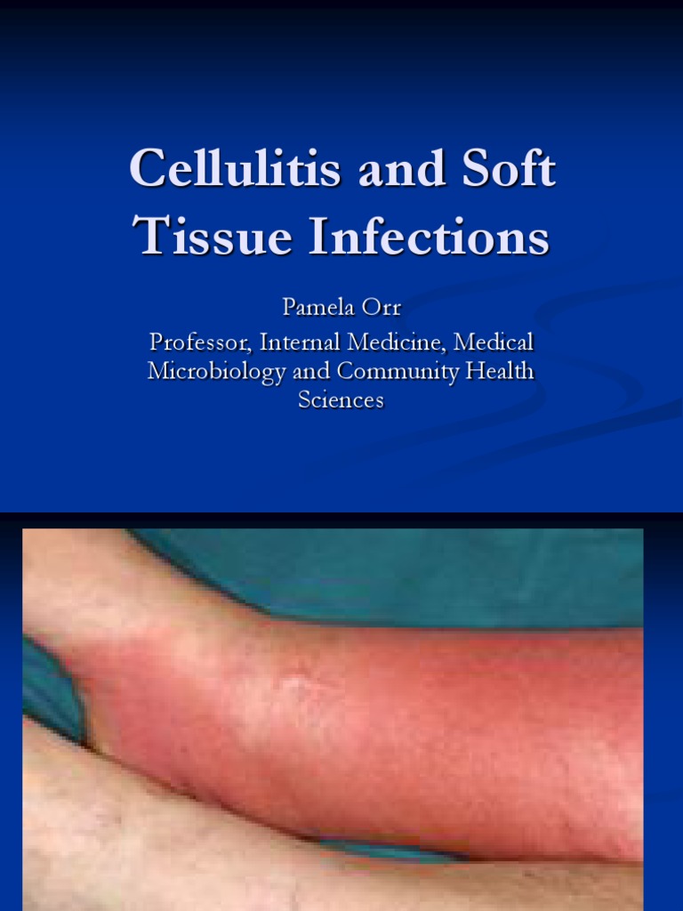 Cellulitis