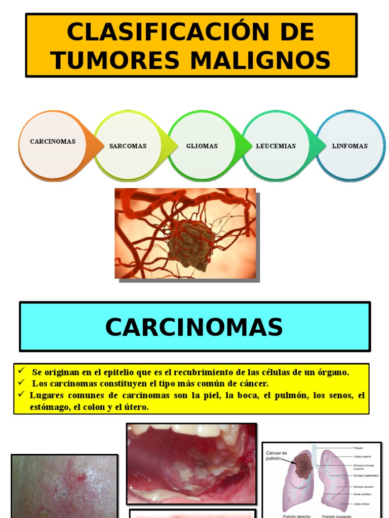 Clasificación de Tumores Malignos Maoly | PDF | Neoplasias | Sarcoma