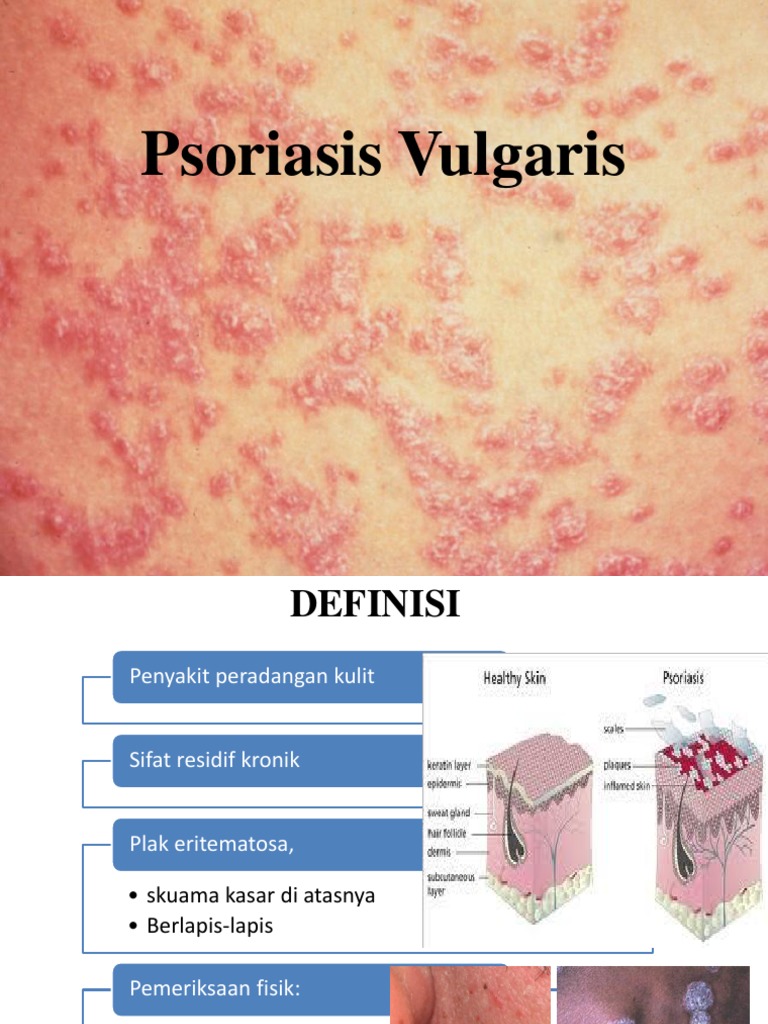 Psoriasis | PDF | Kesehatan Holistik