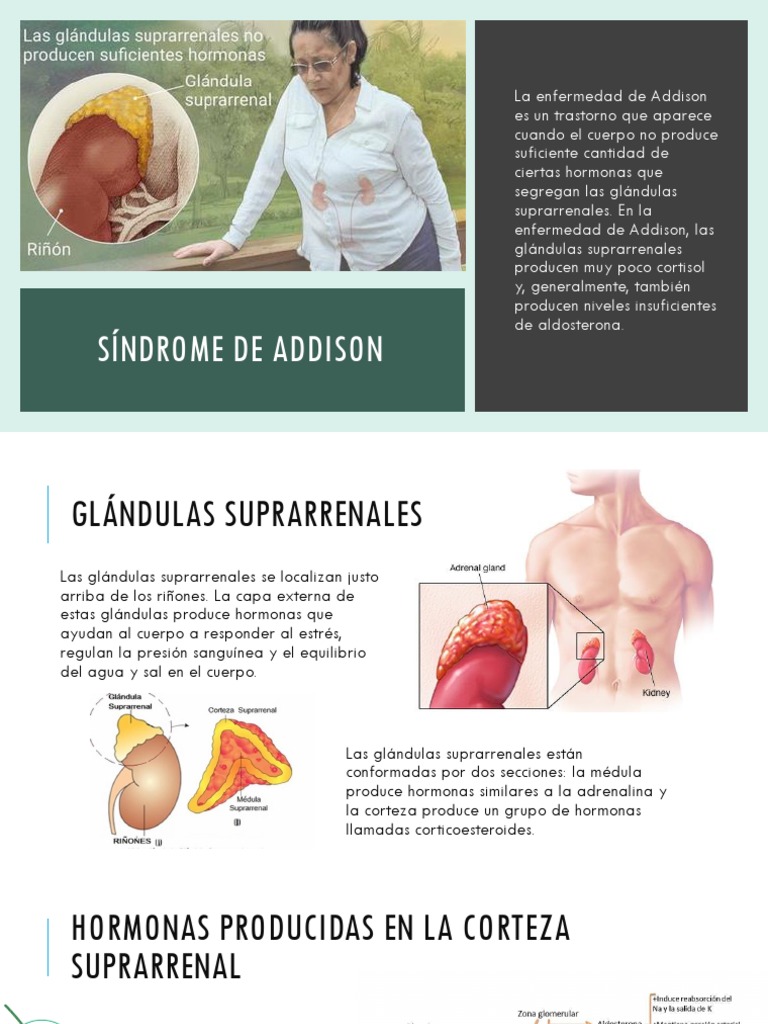 Síndrome de Addison: Guía Completa | PDF | Glándula suprarrenal ...