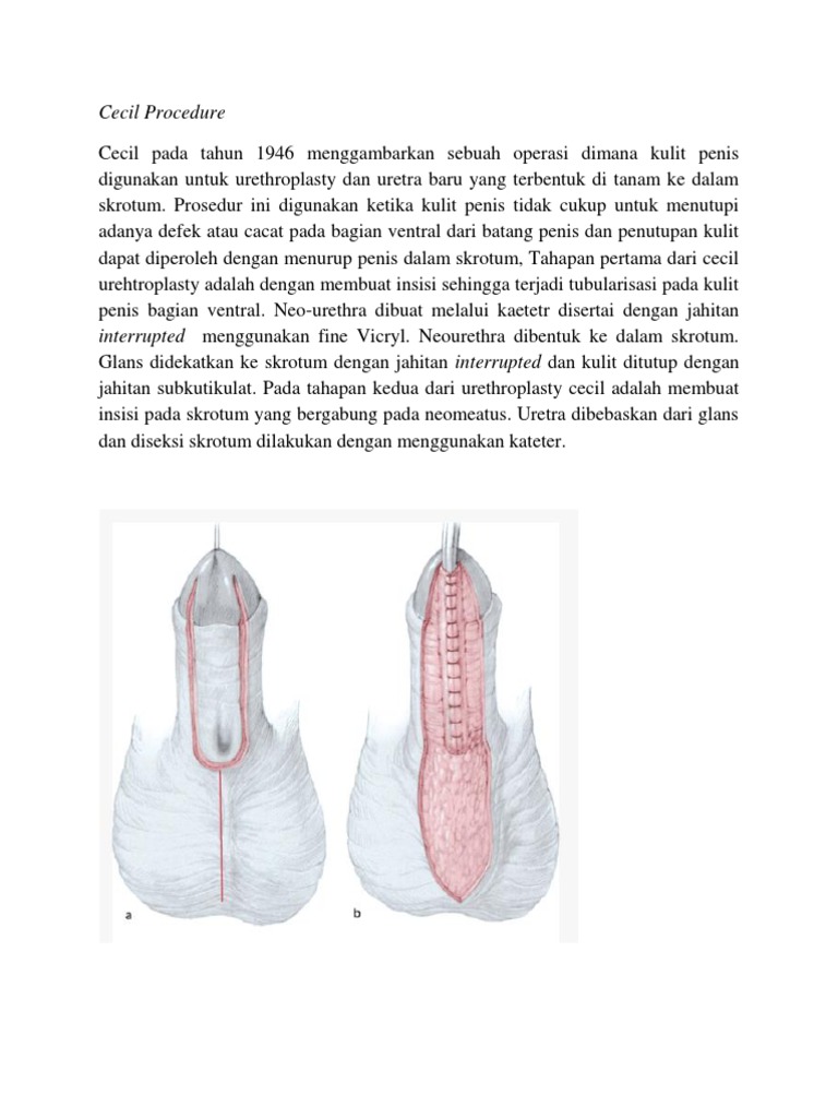 Cecil Procedure | PDF | Ilmu Sosial | Seni