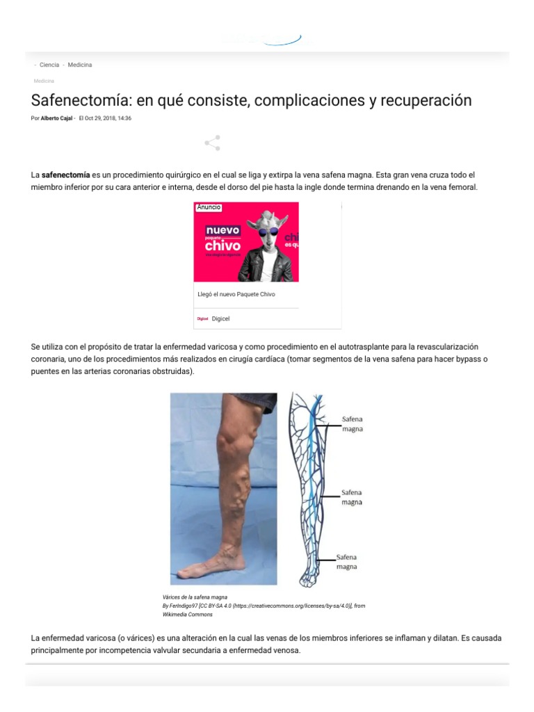 Safenectomía - en Qué Consiste, Complicaciones y Recuperación - Lifeder ...