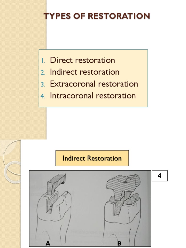 Types of Restoration: Direct Restoration Indirect Restoration ...