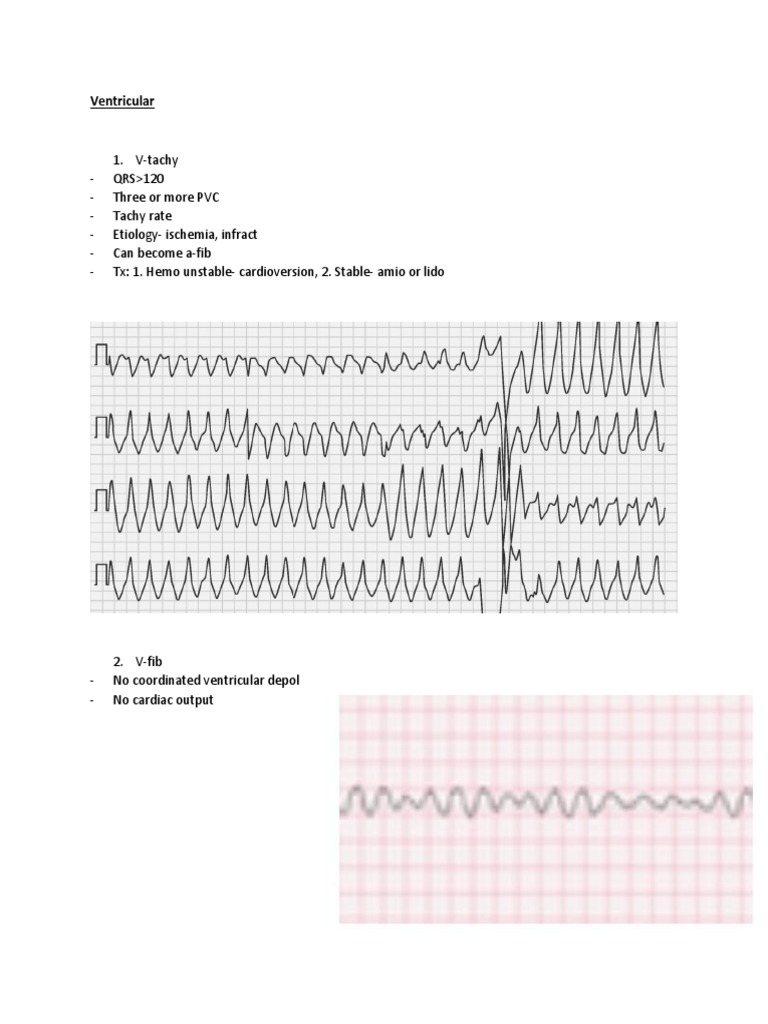 V-Tachy - QRS 120 - Three or More PVC - Tachy Rate - Etiology-Ischemia ...