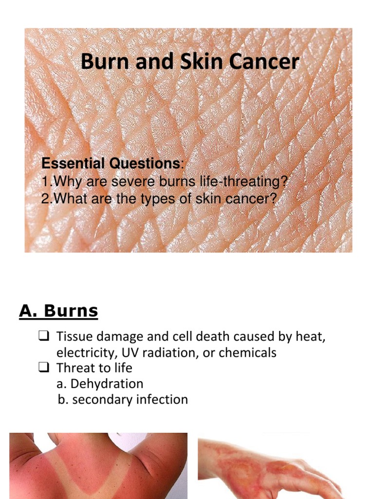 Burn and Skin Cancer: Essential Questions | PDF