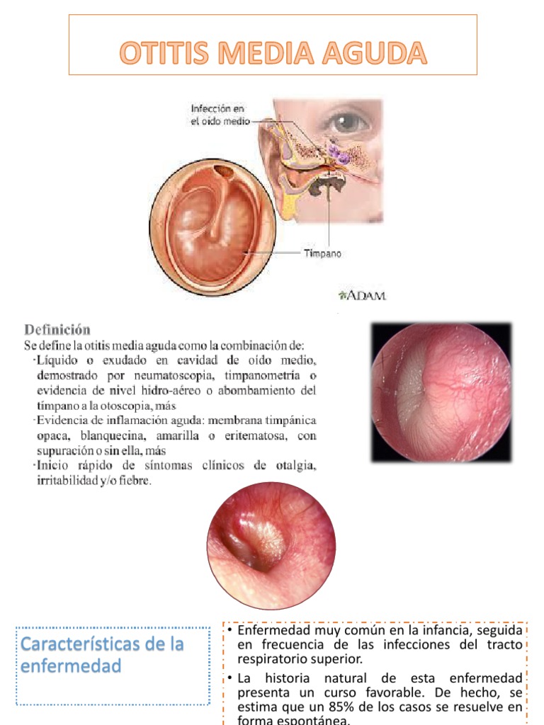 Características, diagnóstico y manejo de la otitis media aguda | PDF ...