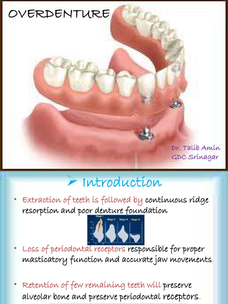 An In-Depth Review of Overdentures: Indications, Types, Advantages and ...