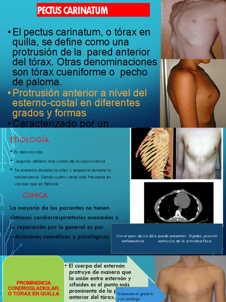 Pectum Carinatum | PDF | Tórax | Medicina