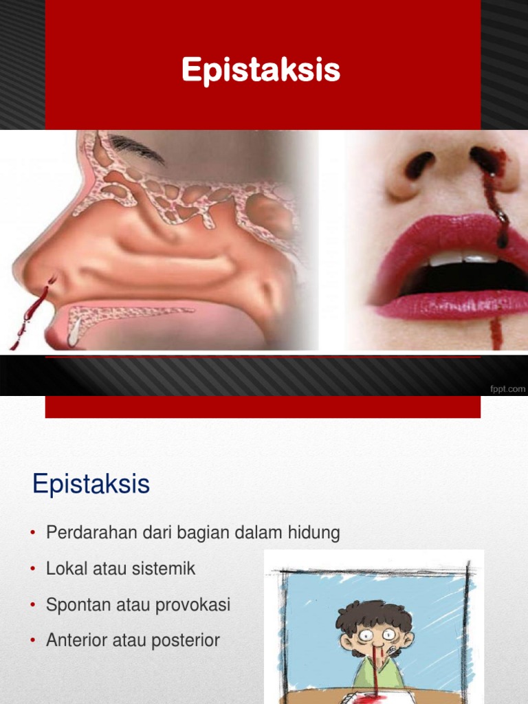 Epistaksis Tan | PDF | Sains & Matematika