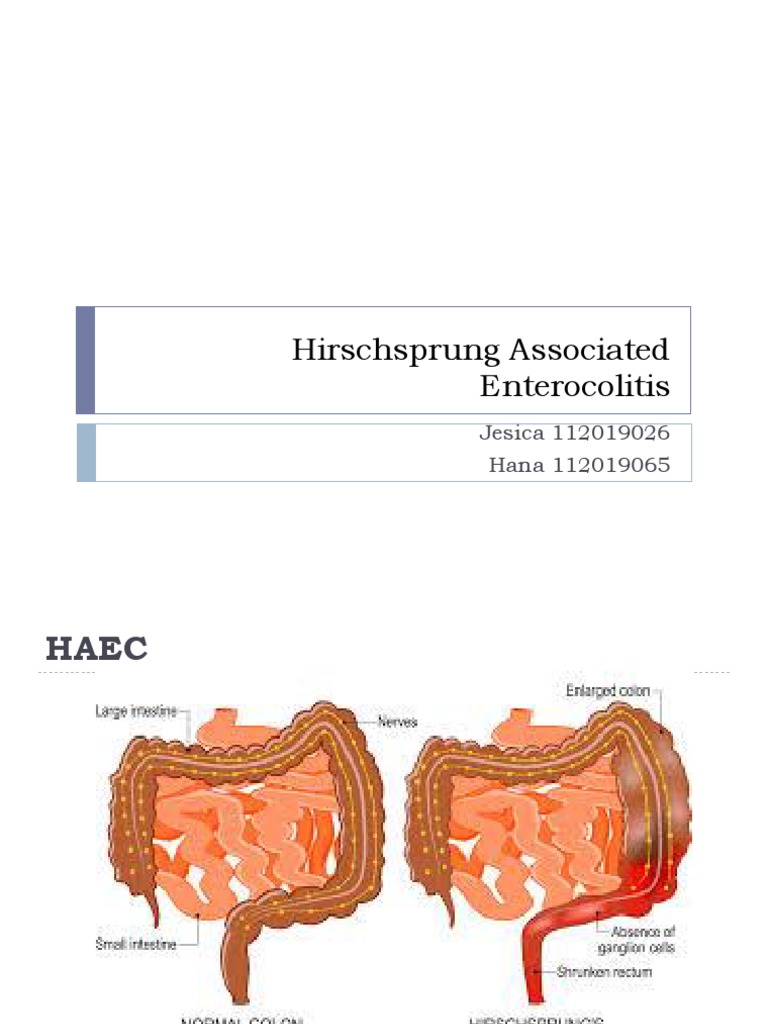 Hirschsprung Associated Enterocolitis (HAEC) | PDF