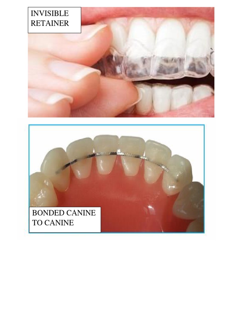 Types of Dental Retainers Explained | PDF | Foreign Language Studies