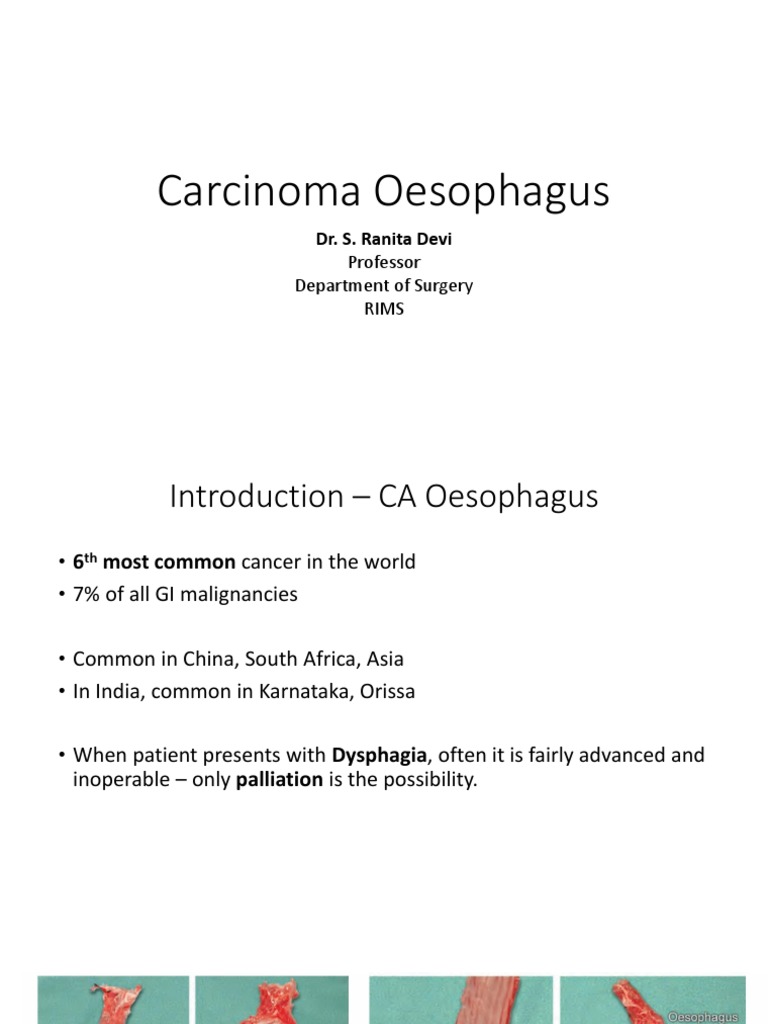 Shouldering Sign in Oesophageal Carcinoma | PDF | Esophagus ...