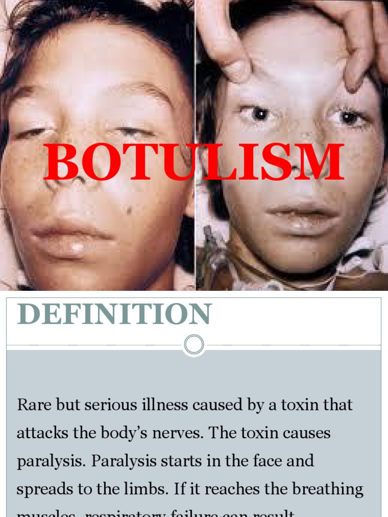 Botulism: BSN Ii - A | PDF