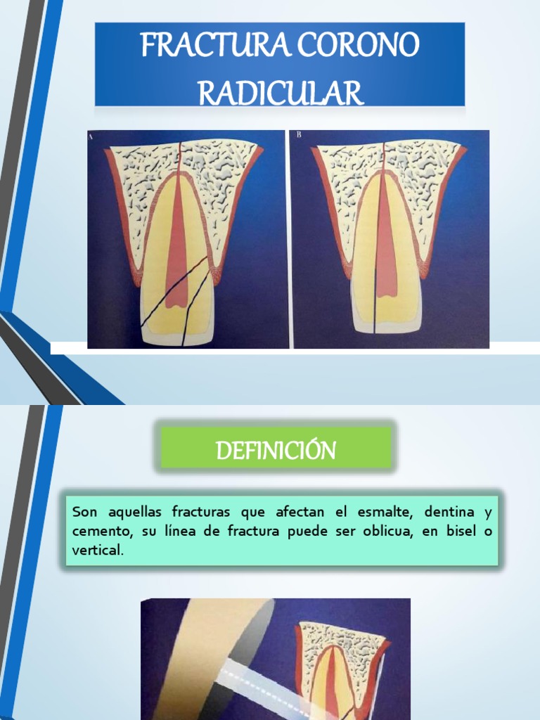 Fractura Corono-Radicular | PDF | Ciencias de la Salud | Enfermedades y ...
