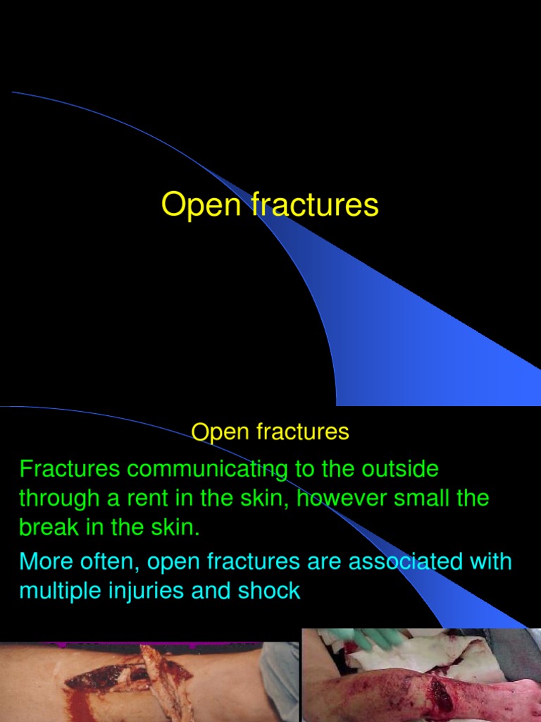 Open Fracture | Download Free PDF | Surgical Specialties | Clinical ...