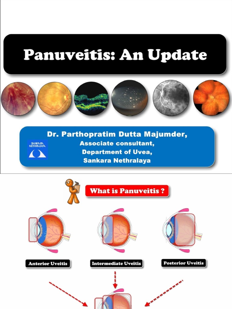 Panuveitis SAARC - PPT (Autosaved) | PDF