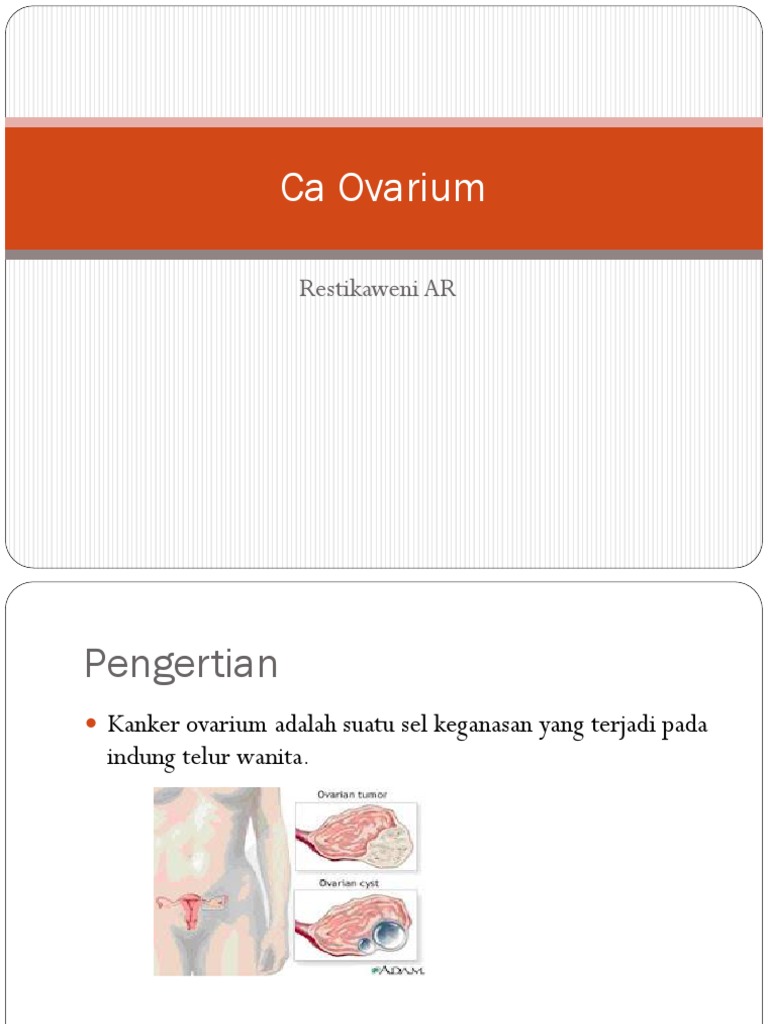 CA Ovarium | PDF