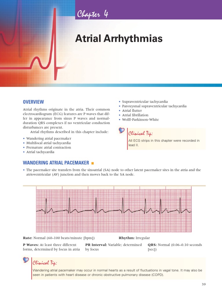 Wandering Atrial Pacemaker Rhythm Strip