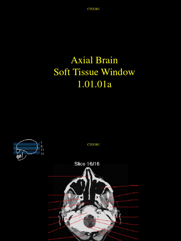 Axial Brain Soft Tissue Window 201a | PDF