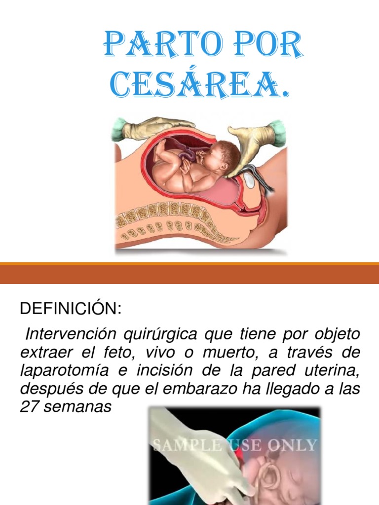Tipos y técnica de cesárea | PDF | El embarazo | Parto