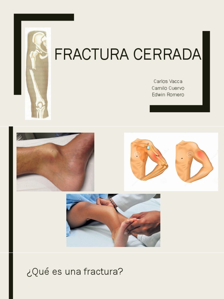 Fractura Cerrada | PDF | Hueso | Ciencias de la Salud