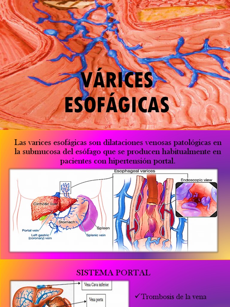 Várices Esofágicas | PDF | Rtt | Epidemiología