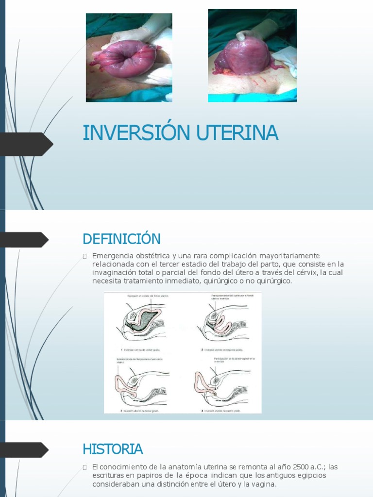 Manejo de la Inversión Uterina | PDF | Útero | Parto