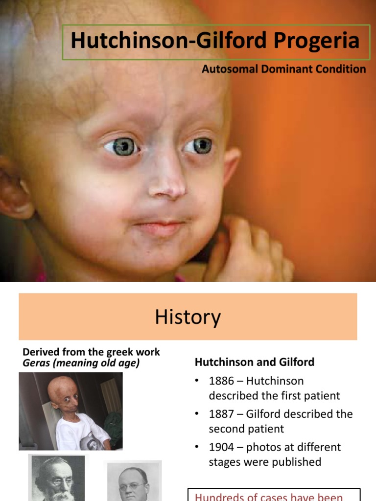 What Is Hutchinson-Gilford Progeria at Johnathan Karen blog