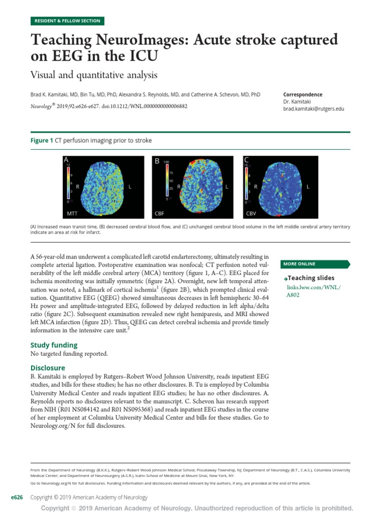Acute Stroke Captured - On EEG in The ICU PDF | PDF ...