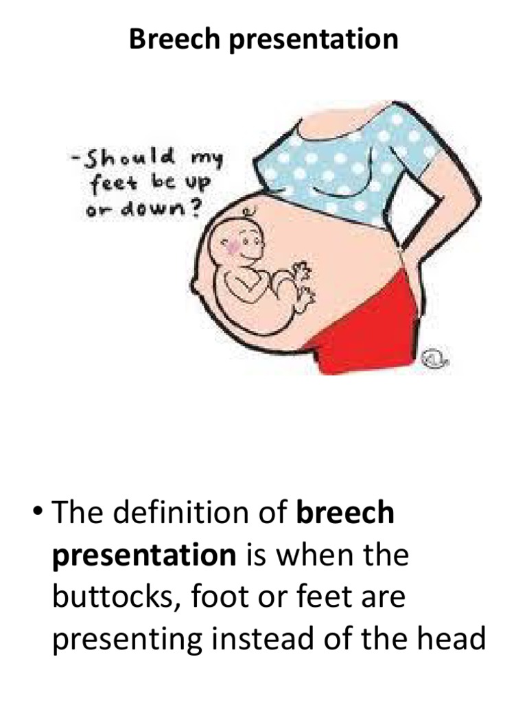 Breech Presentation | PDF | Caesarean Section | Childbirth