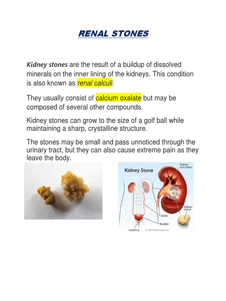 Renal Stones | PDF | Kidney | Ct Scan