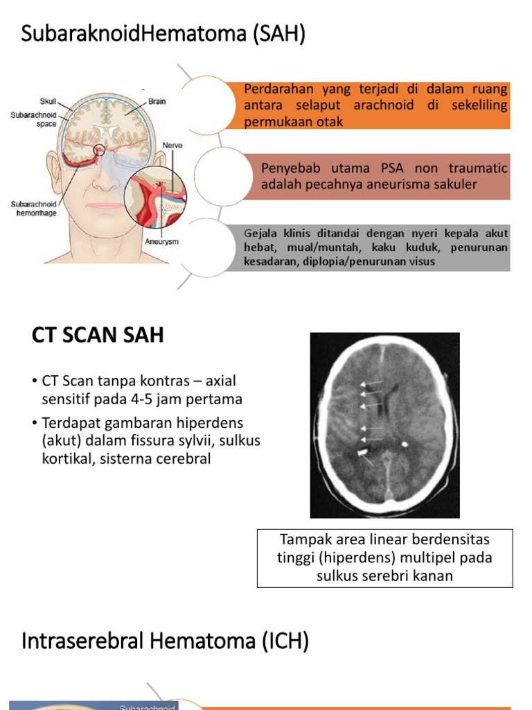 CT Scan SAH IVH ICH | PDF