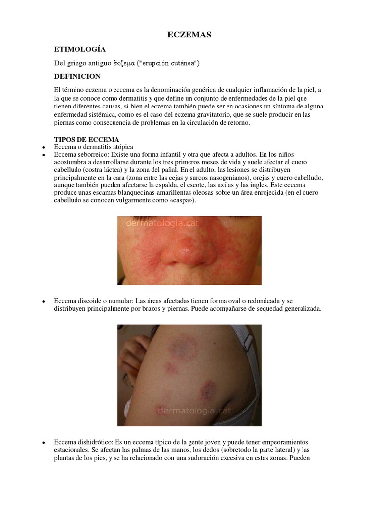 Eczema S | PDF | Alergia | Psoriasis