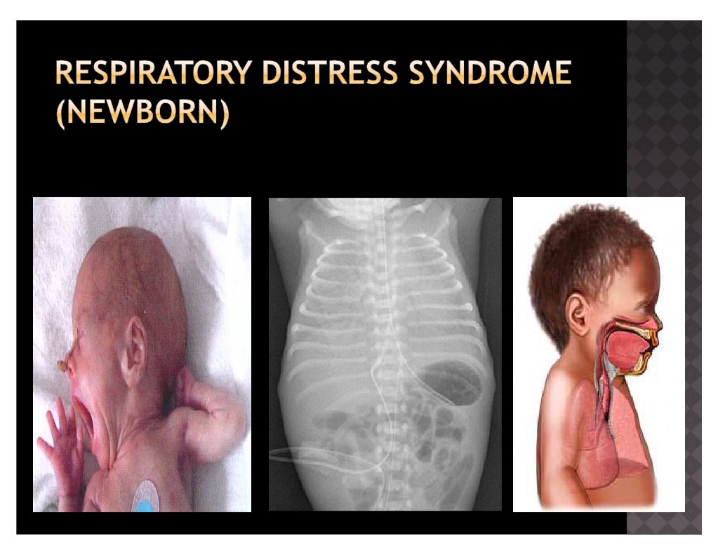Respiratory Distress Syndrome (Newborn) | PDF