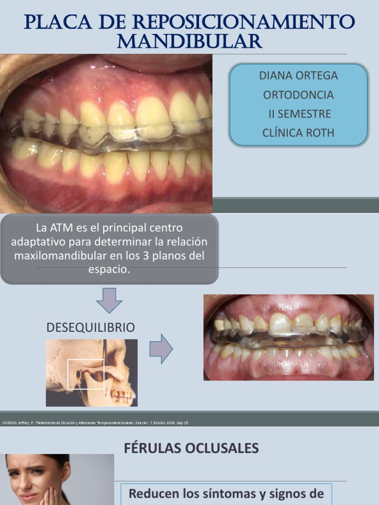 Placa de Reposicionamiento Mandibular | PDF | Ortodoncia | Odontología