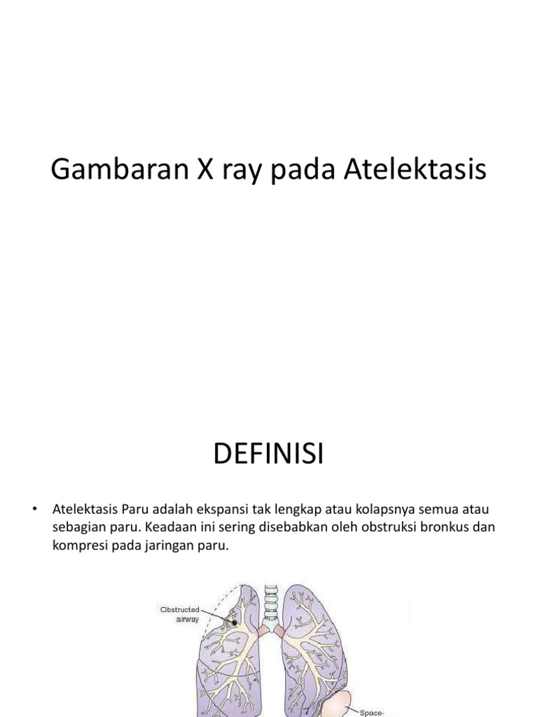 Atelektasis X Ray | PDF