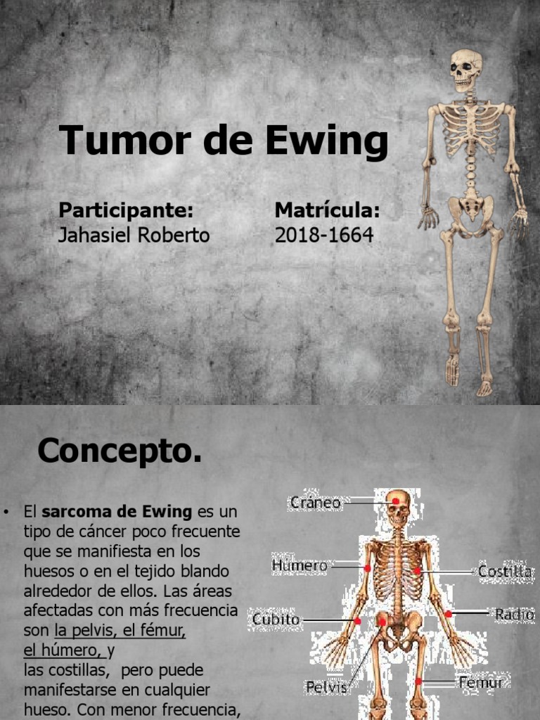 Exposición - Tumor de Ewing | PDF | Sarcoma | Cáncer