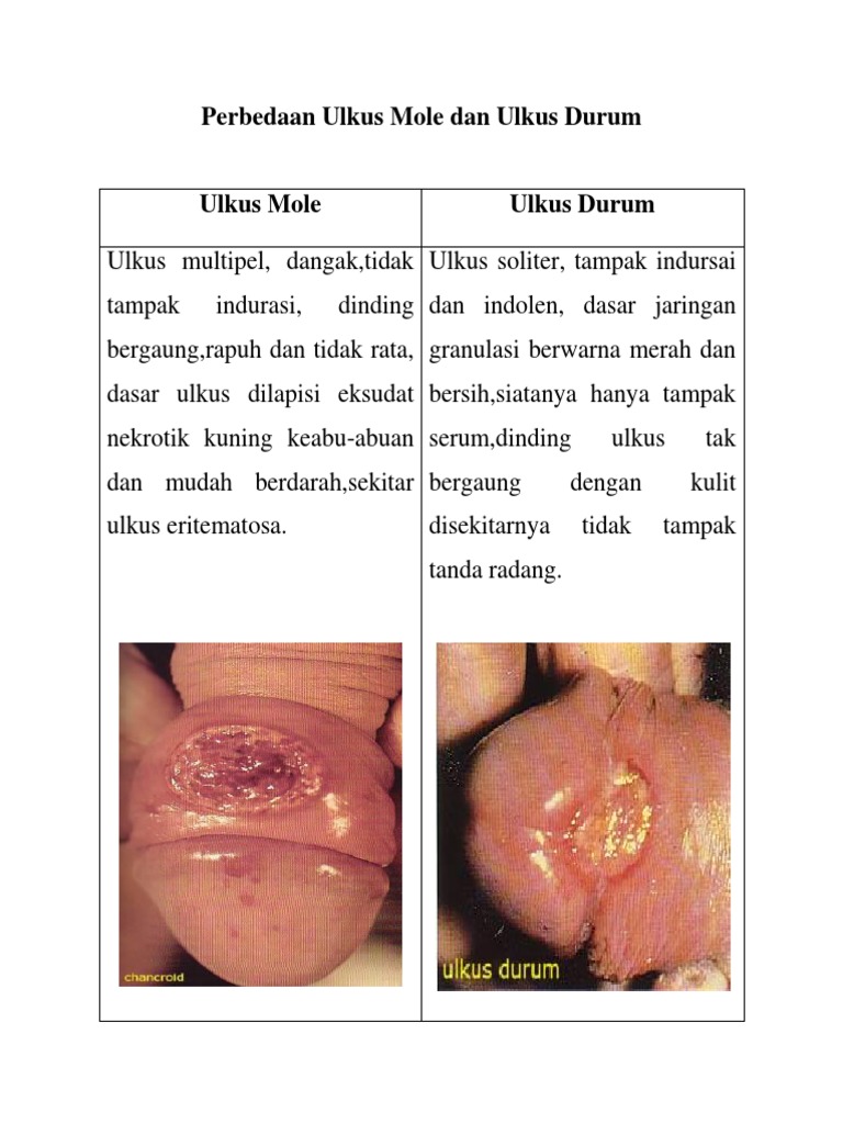 Perbedaan Ulkus Mole Dan Ulkus Durum | PDF