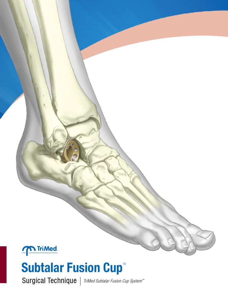 Subtalar Fusion Cup PDF | PDF | Foot | Lower Limb Anatomy