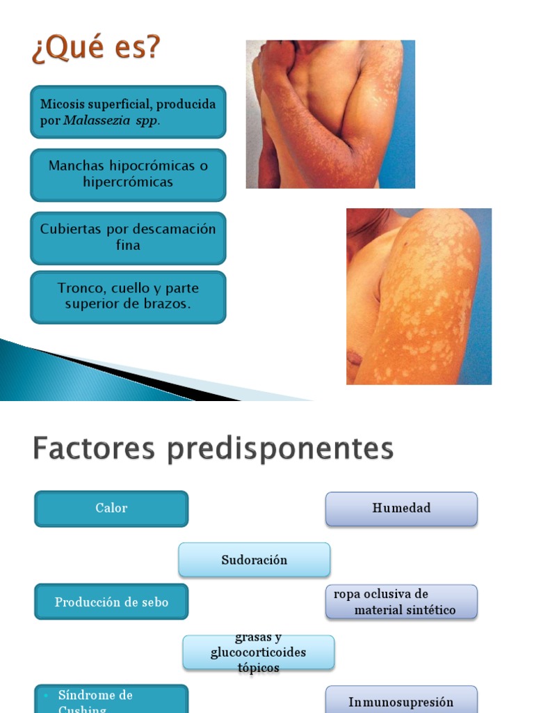 Pitiriasis Versicolor | PDF