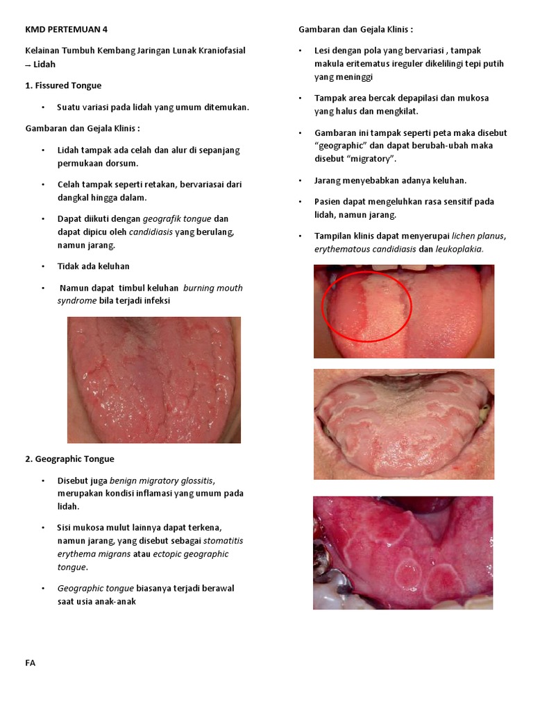 Kelainan Lidah: Makroglosia dan Gejala | PDF