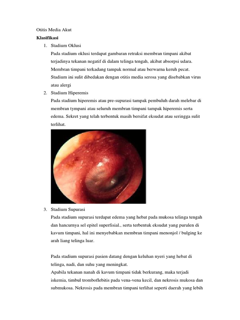 Otitis Media Akut | PDF