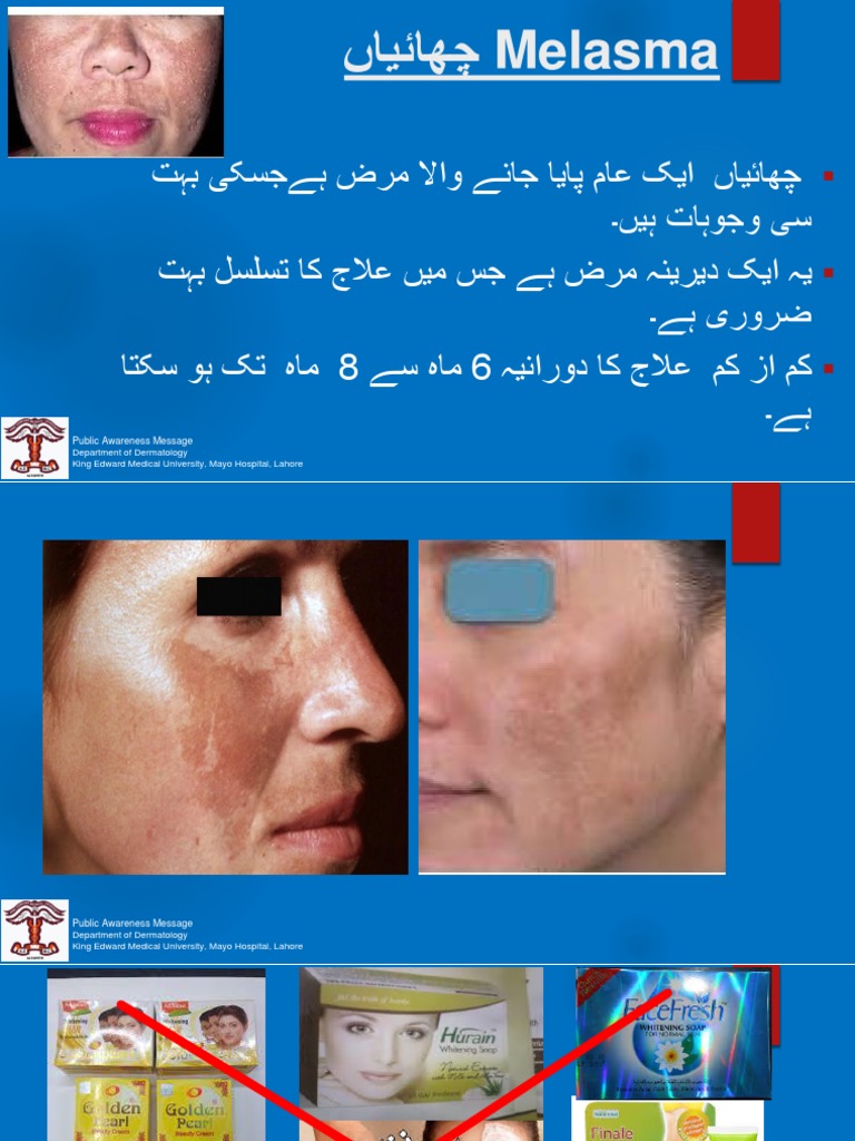 Melasma PPT Final | PDF